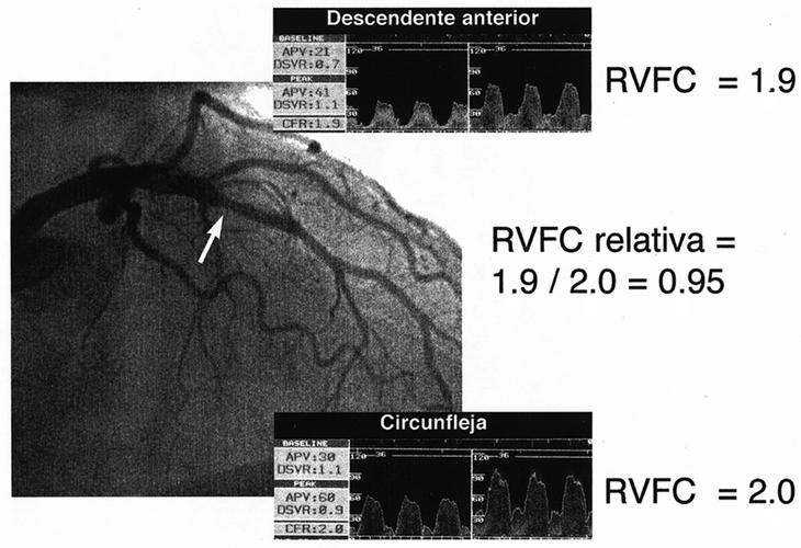 Valoración fisiológica de la circulación coronaria. Papel de las ...