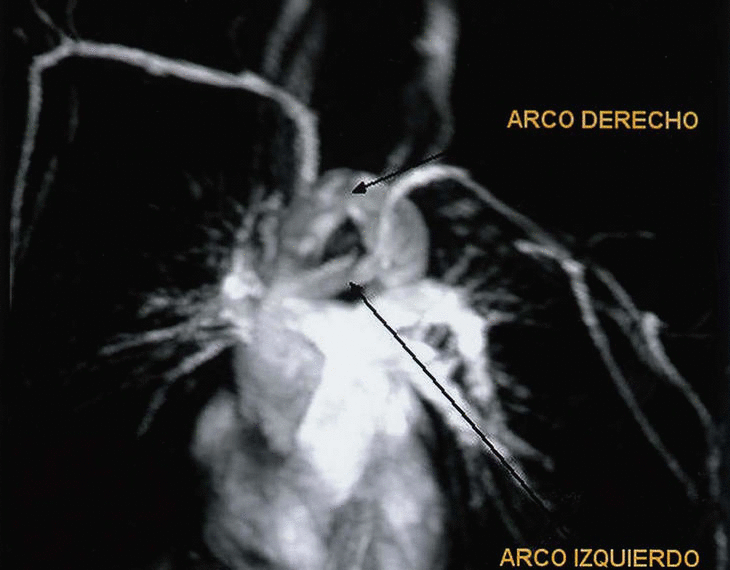 Doble arco aórtico | Revista Española de Cardiología