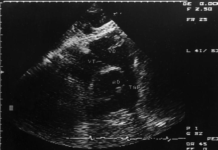 Valoración de la función ventricular derecha mediante ecocardiografía ...