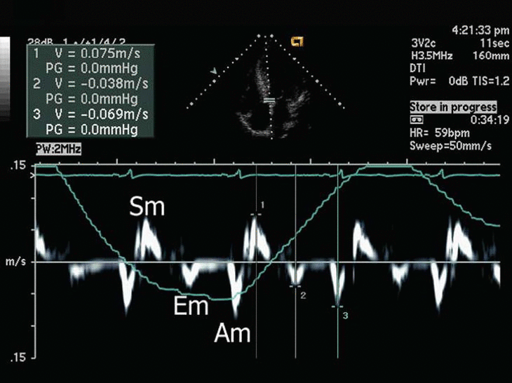 Diagnóstico y guía terapéutica de la insuficiencia cardíaca diastólica ...