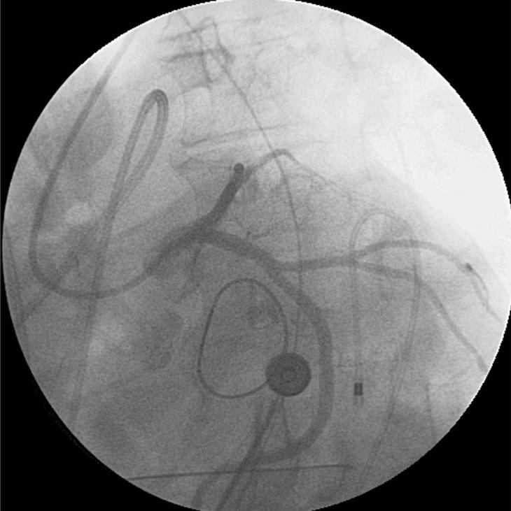 Intervencionismo coronario en la oclusión iatrogénica de circunfleja ...