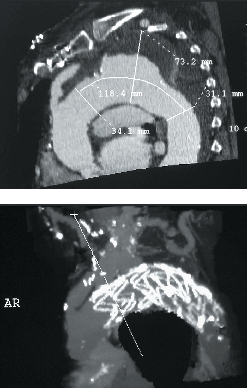 Tratamiento percutáneo de las afecciones de la aorta torácica. Una ...