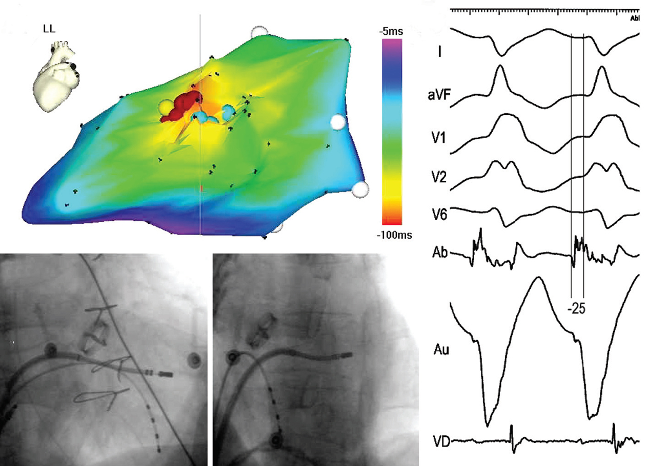 Optimización del abordaje transeptal para la ablación de una ...