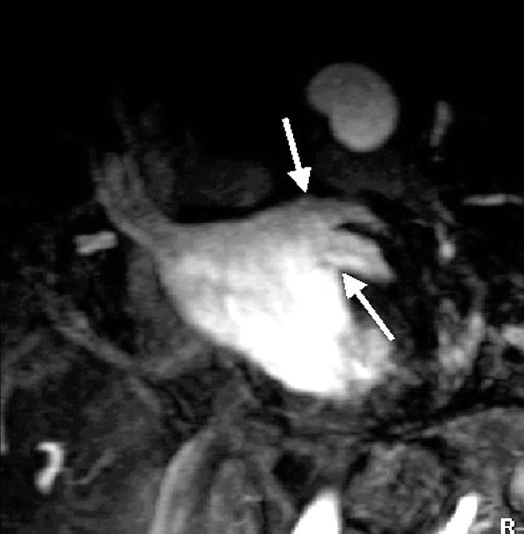 Estudio morfológico de las venas pulmonares por angiorresonancia ...