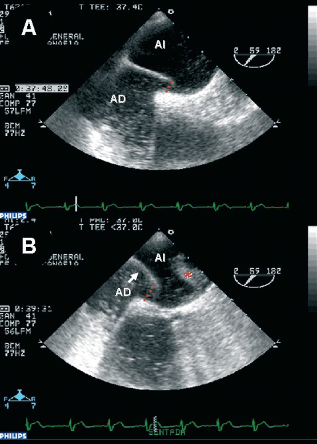 Cierre percutáneo de foramen oval permeable en el síndrome platipnea ...