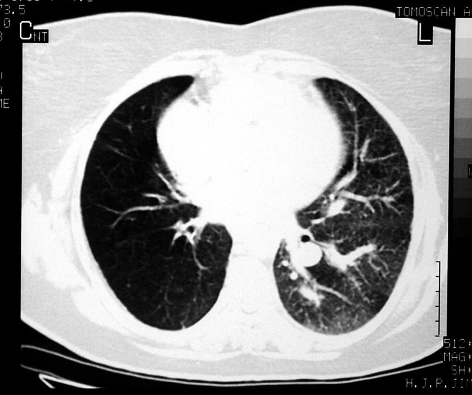 Edema de pulmón unilateral e hipertensión pulmonar tratada con ...