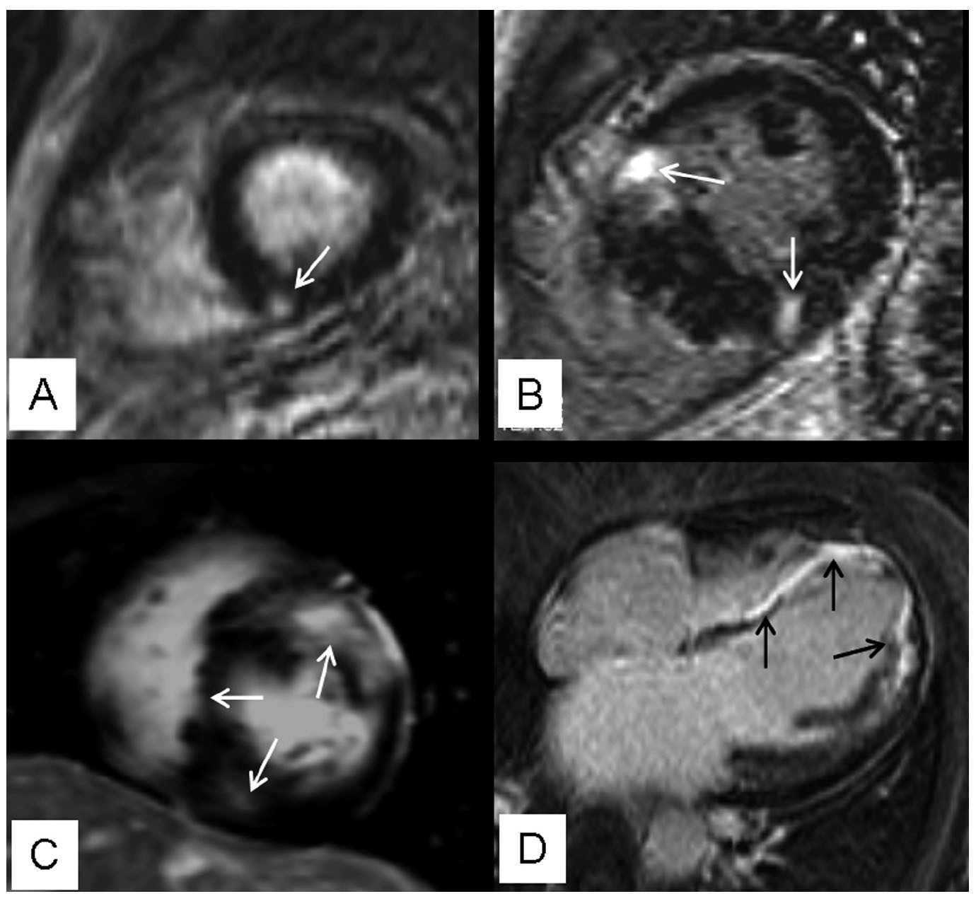 Detección y cuantificación de la fibrosis miocárdica en la ...