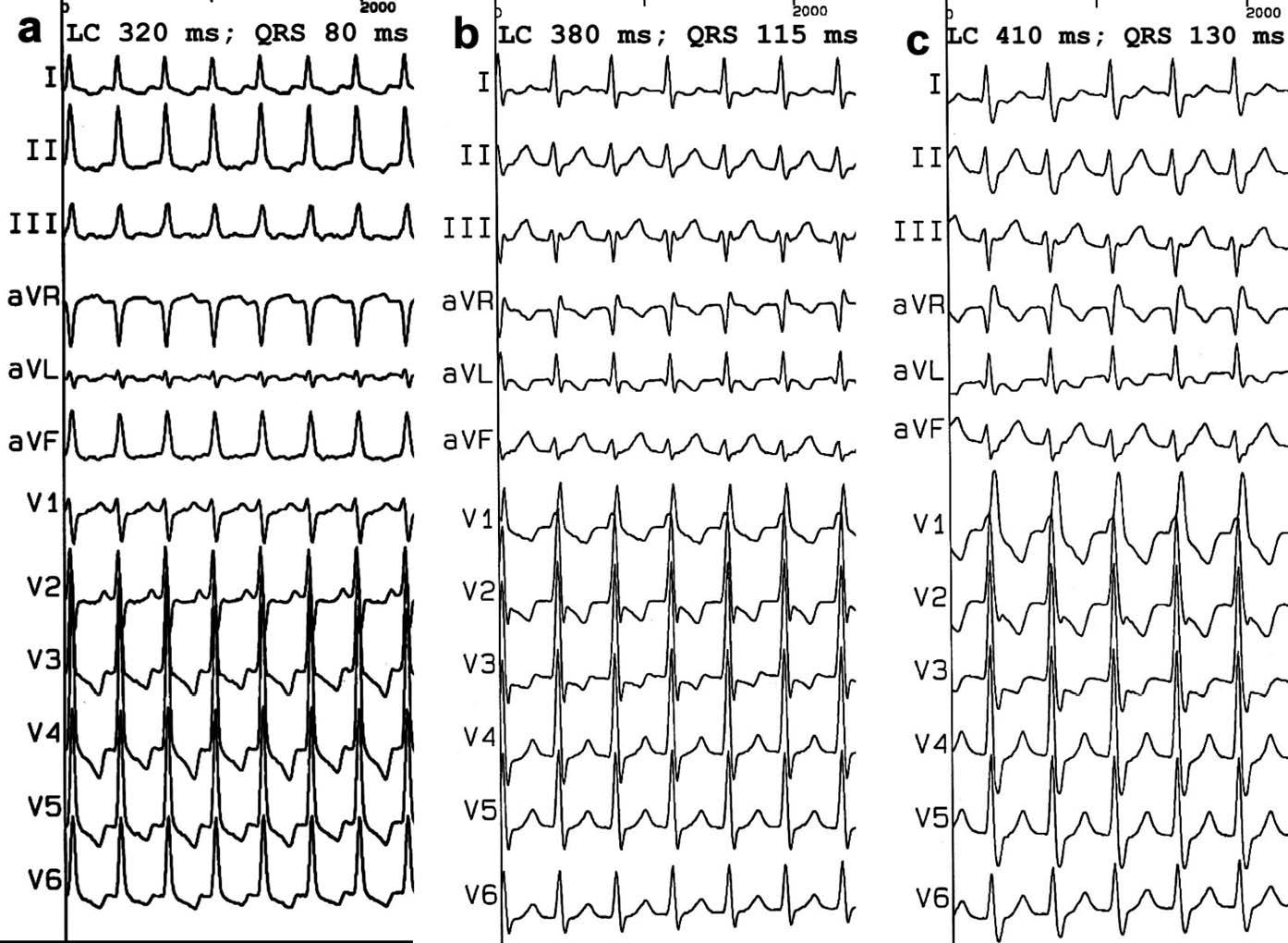 Ablación de una vía accesoria tipo Mahaim conectada al ventrículo ...
