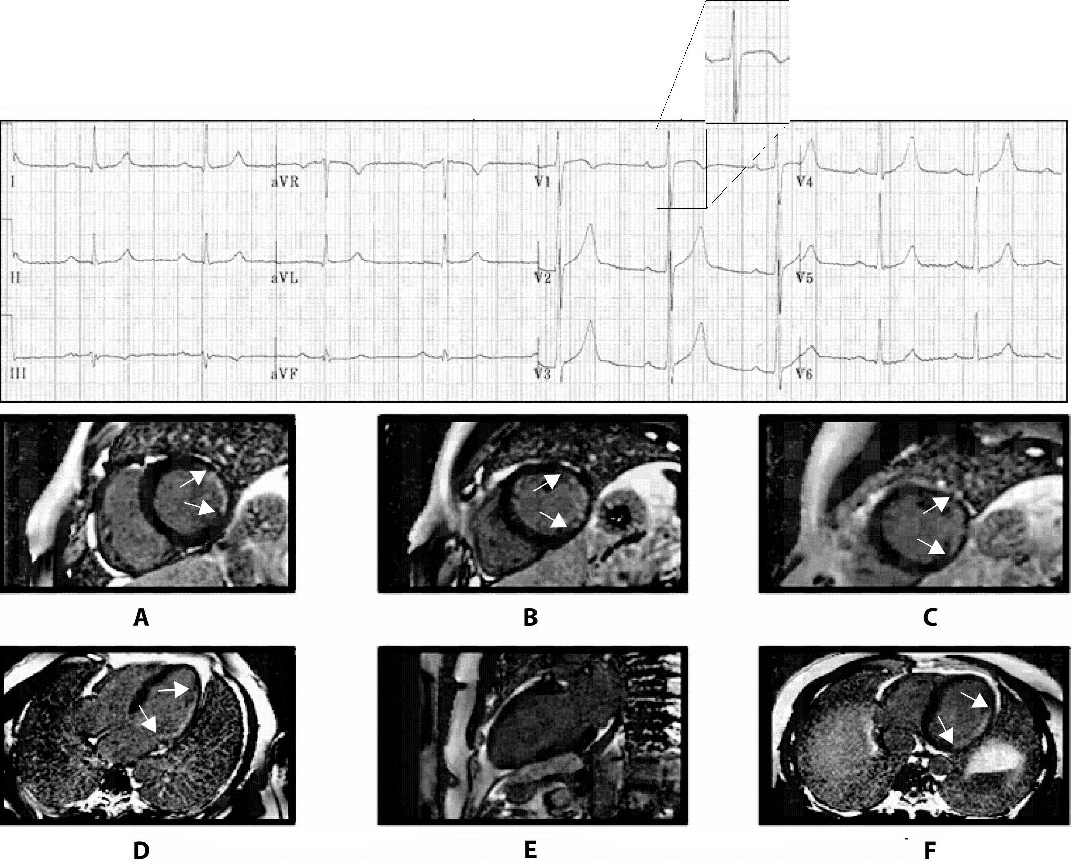 Nueva terminología de las paredes del corazón y nueva clasificación ...