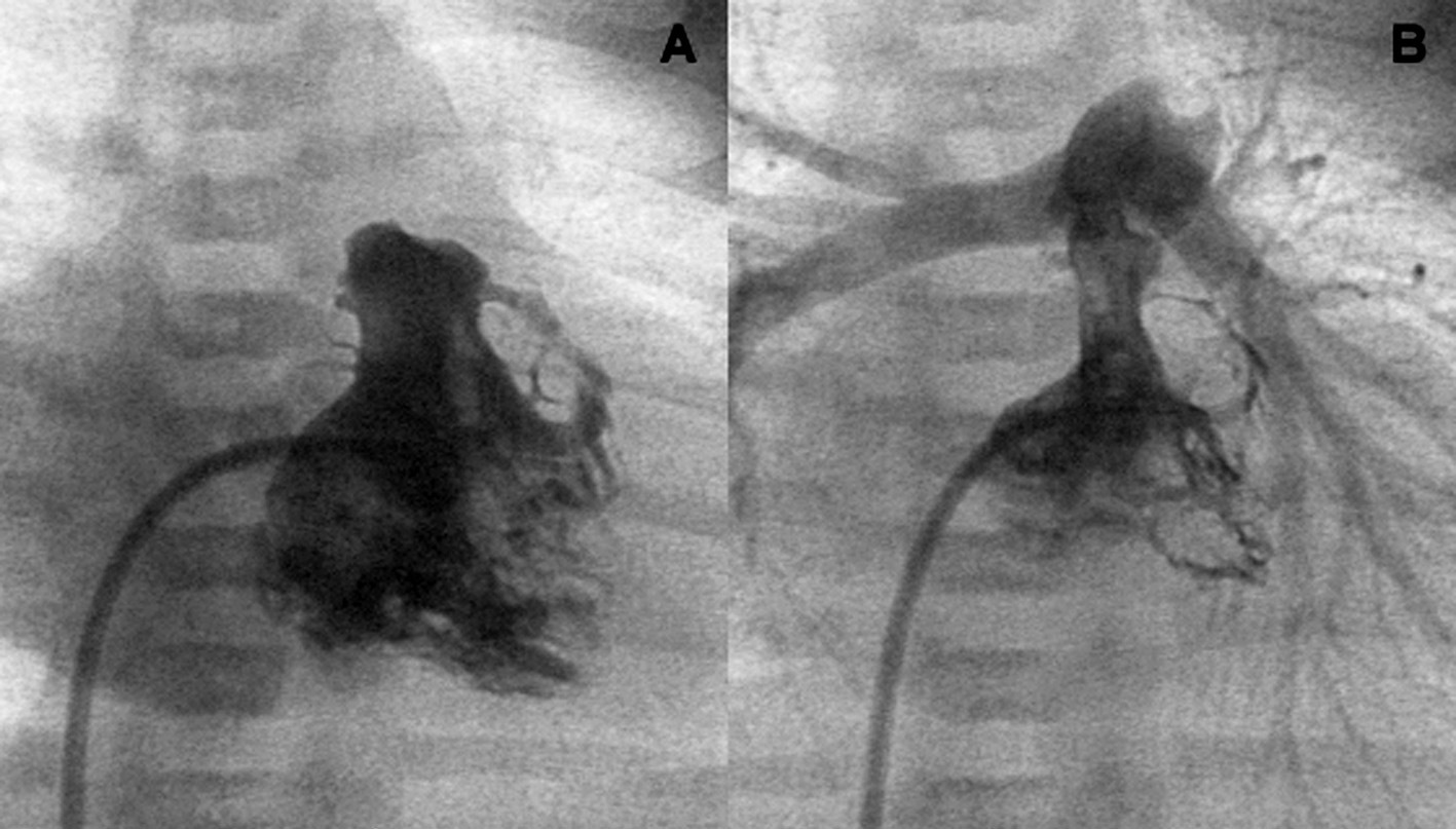 Atresia pulmonar con septo íntegro. Perforación y valvuloplastia ...