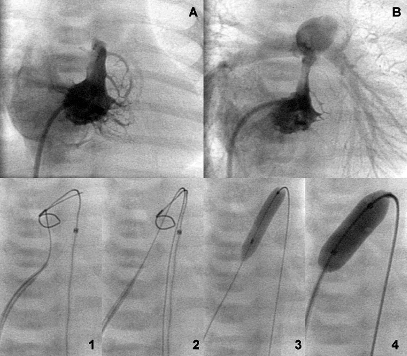 Atresia pulmonar con septo íntegro. Perforación y valvuloplastia ...