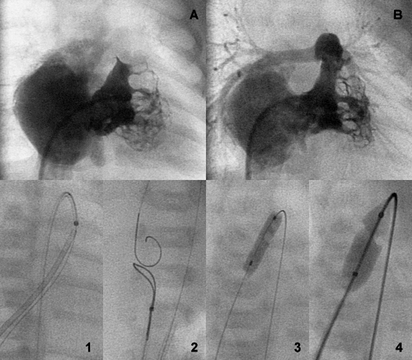Atresia pulmonar con septo íntegro. Perforación y valvuloplastia ...