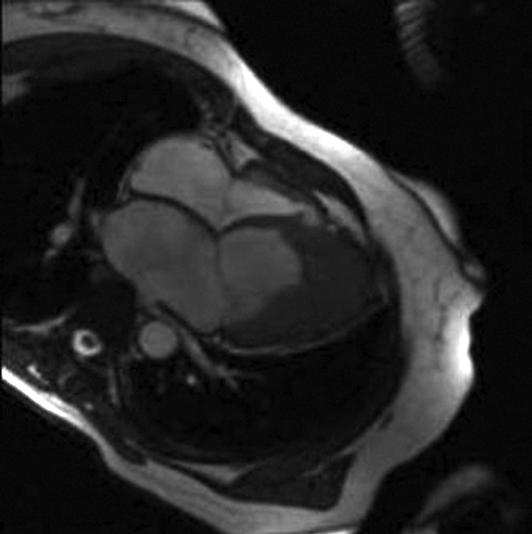 Fibrosis endomiocárdica. Diagnóstico por imagen: realce tardío con ...
