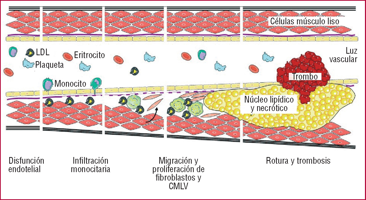Metaloproteasas, remodelado vascular y síndromes aterotrombóticos ...