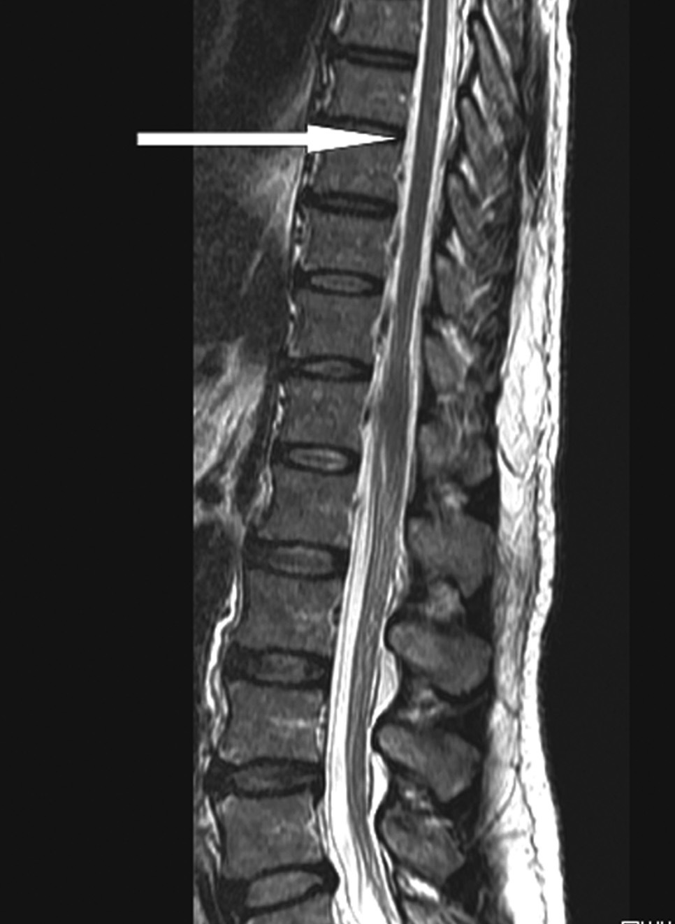 Isquemia medular aguda tras cirugía de disección de aorta ascendente ...