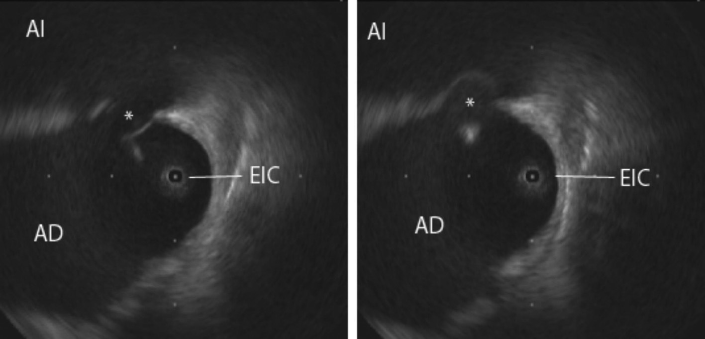 Comunicación interauricular iatrogénica: cierre percutáneo guiado por ...