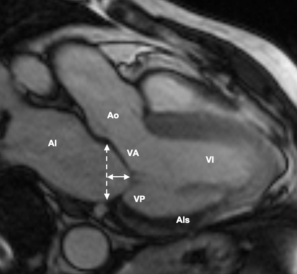 Anuloplastia remodeladora mediante un anillo específico para la ...
