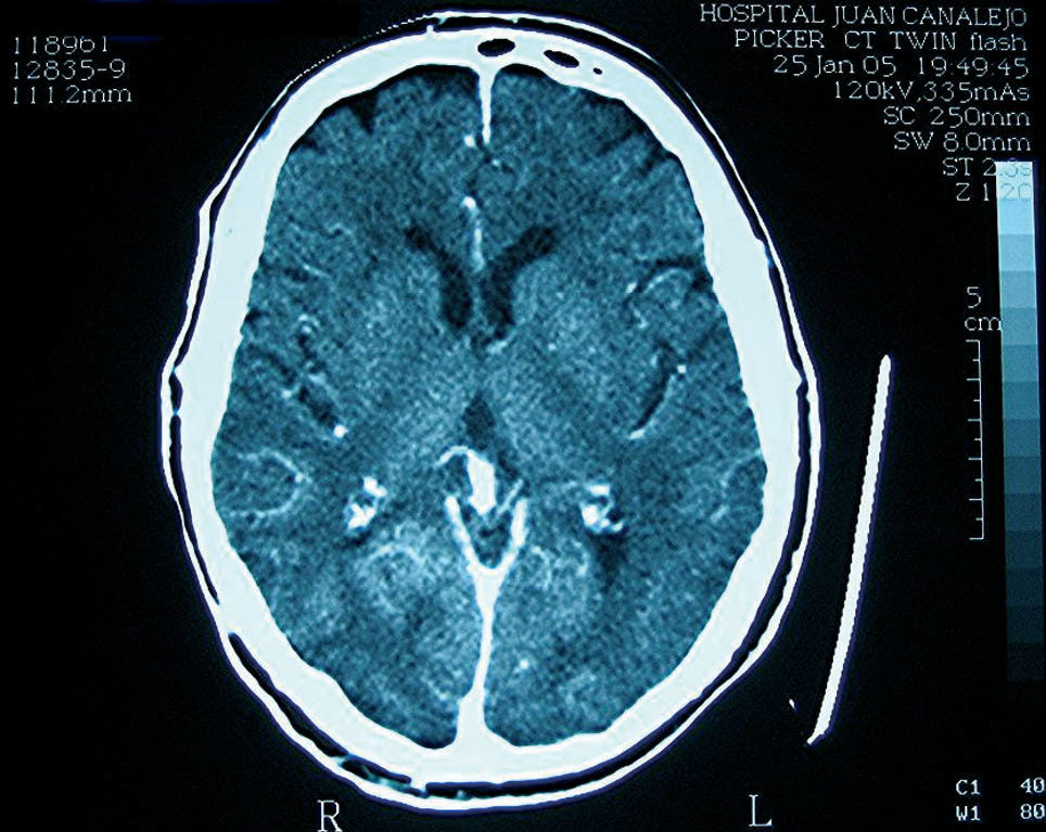 Ceguera cortical transitoria como complicación del cateterismo cardiaco ...