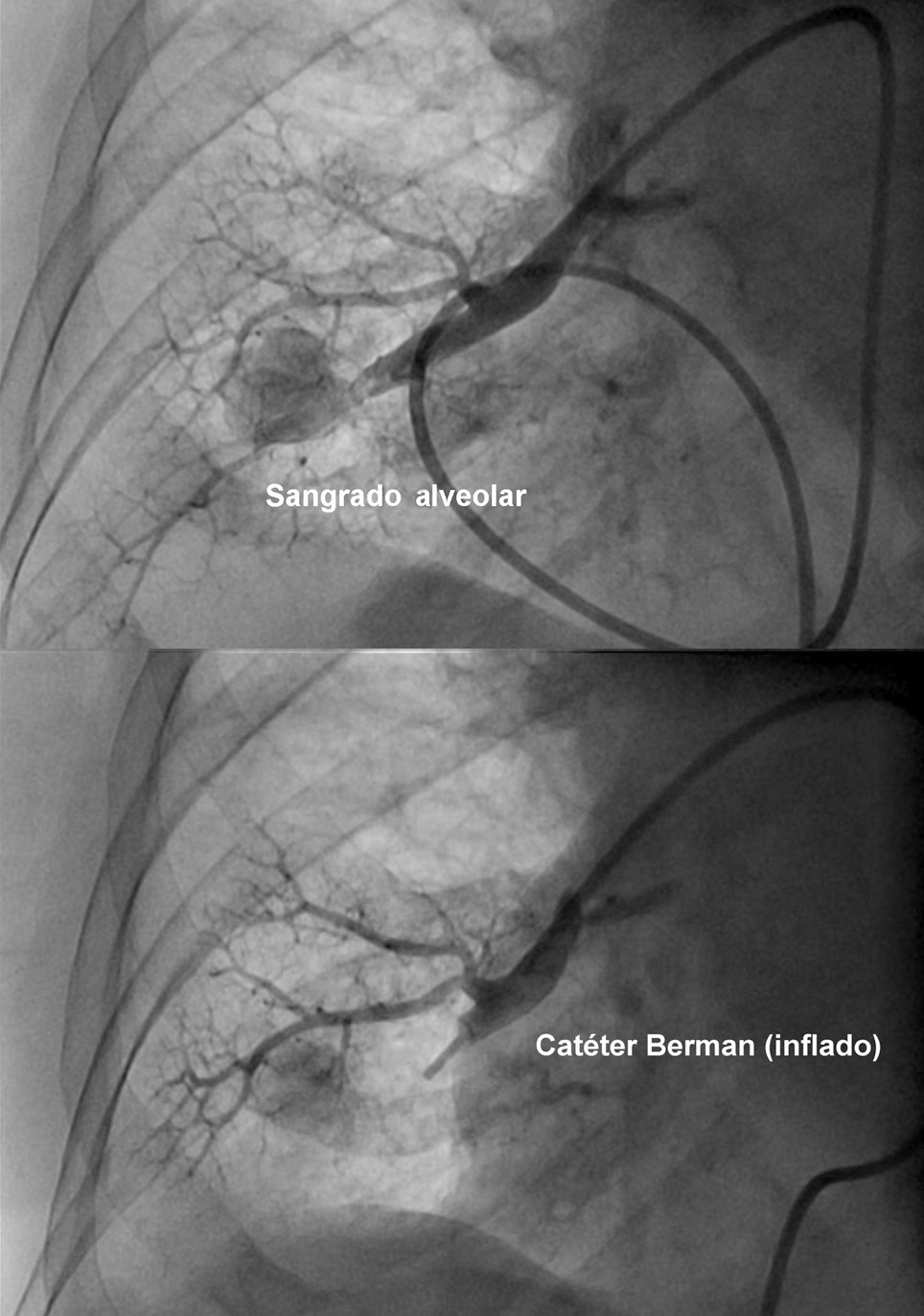 Hemoptisis masiva como complicación inusual de un cateterismo derecho ...