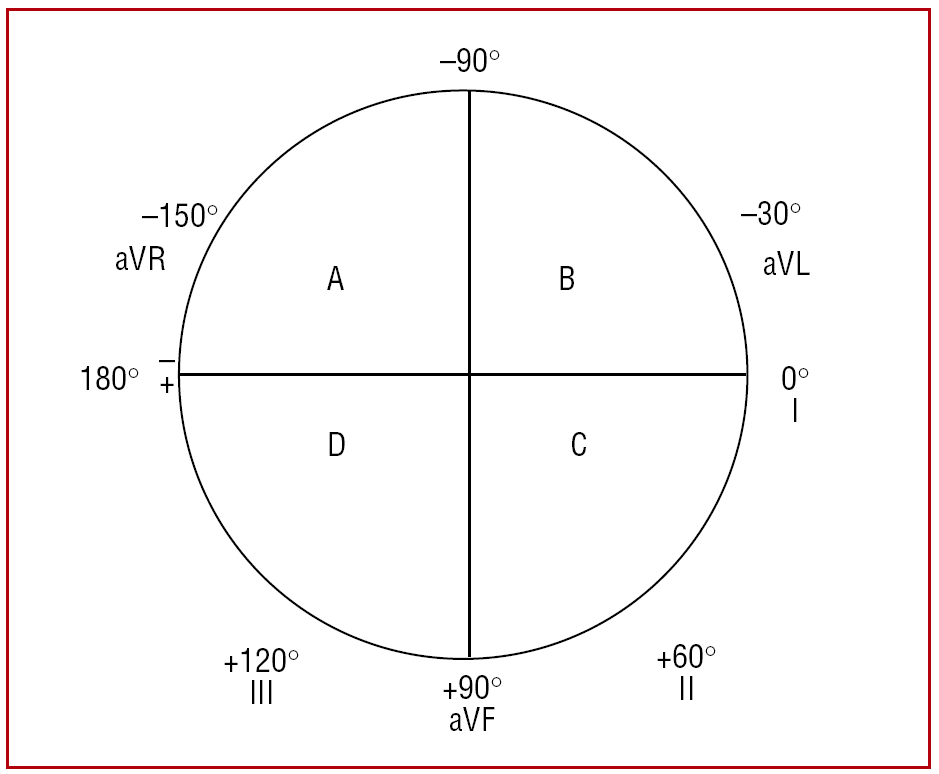 Diagnóstico electrocardiográfico de la obstrucción del tronco coronario ...