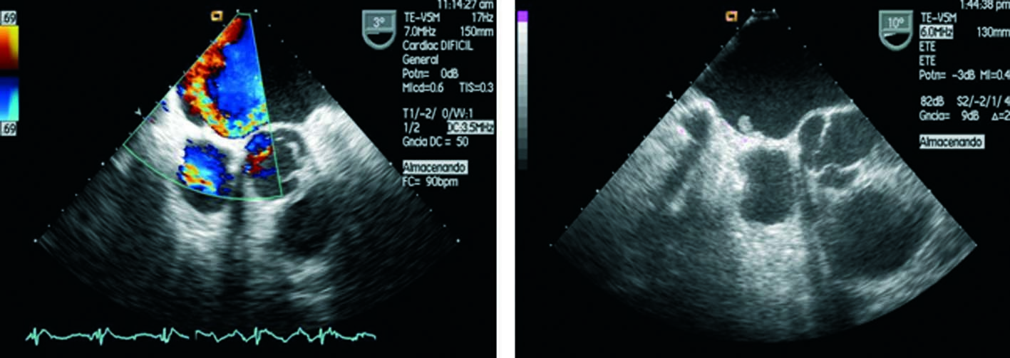 Endocarditis infecciosa sobre septo interauricular por chorro de ...