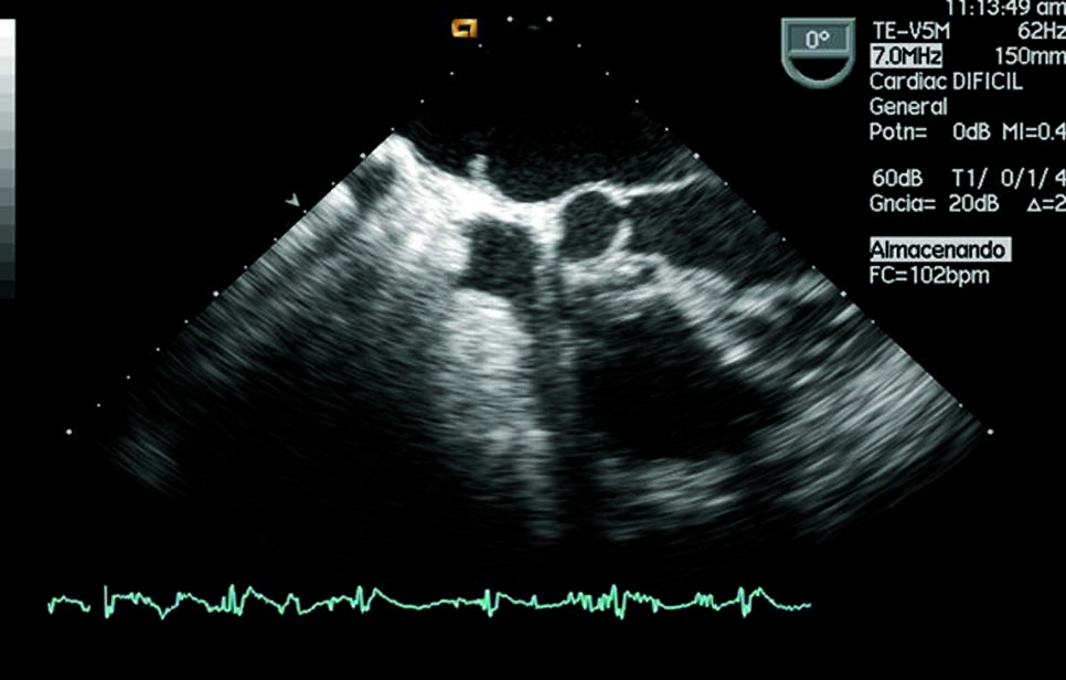 Endocarditis infecciosa sobre septo interauricular por chorro de ...