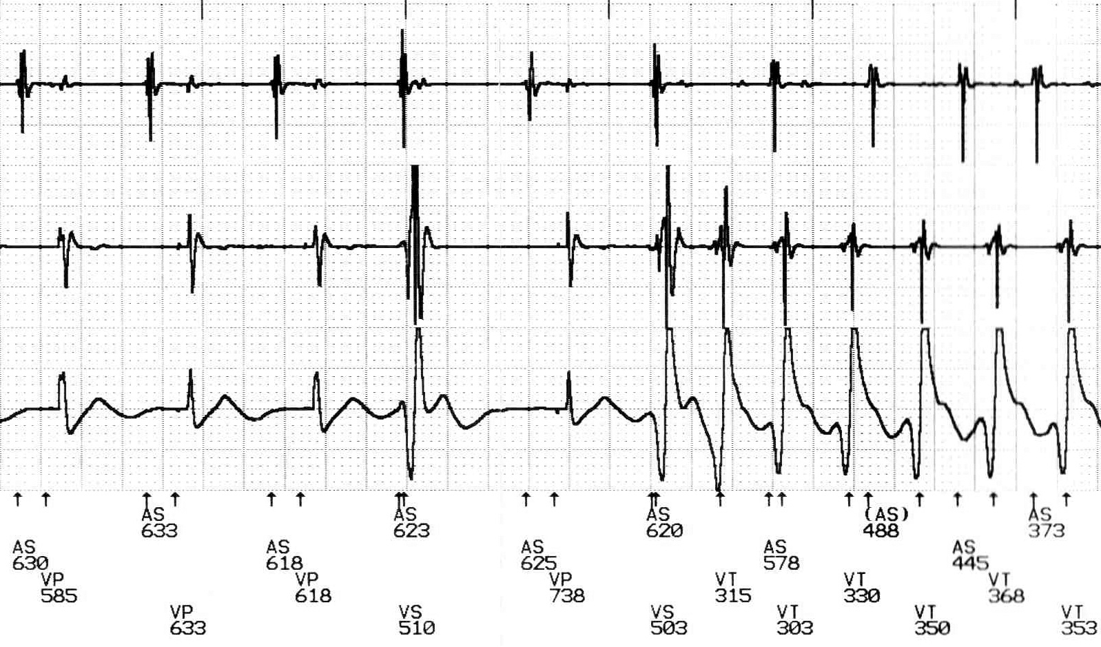 Modos de inicio de taquicardia ventricular monomórfica espontánea en ...