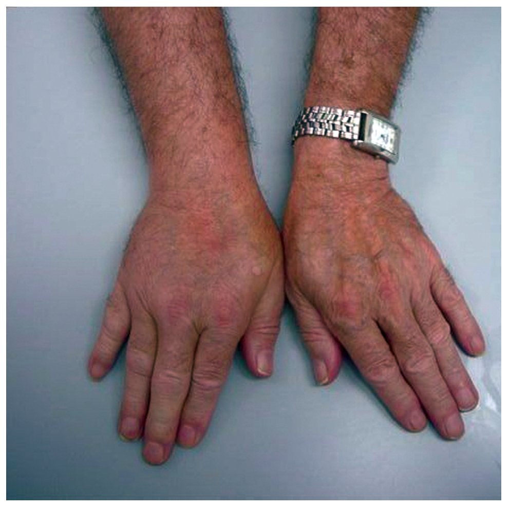 Inhibidores mTOR y edema unilateral | Revista Española de Cardiología