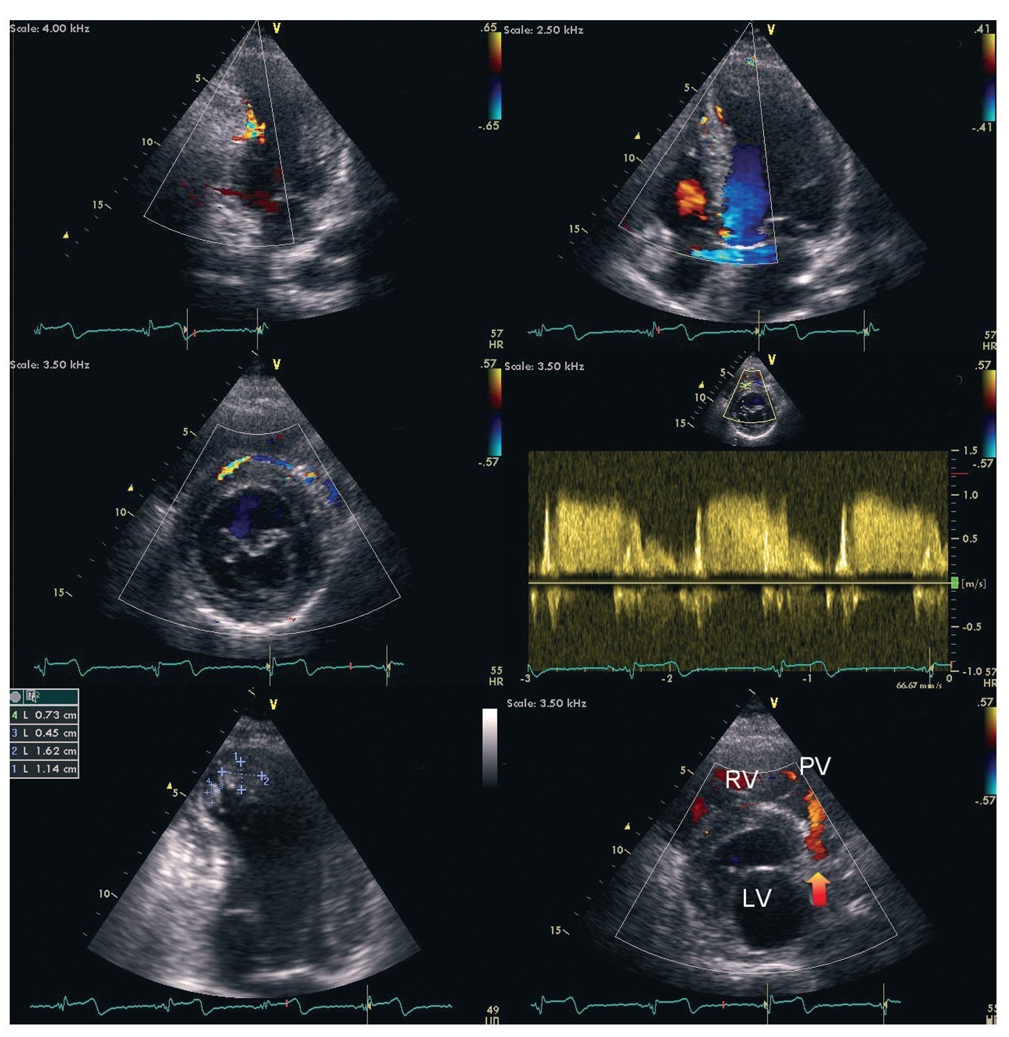 Origen anómalo de la arteria coronaria izquierda: inusual coincidencia ...