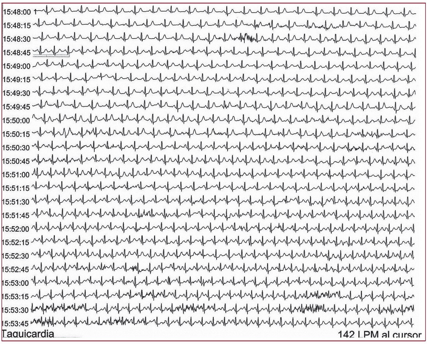 Ivabradina como alternativa terapéutica en la taquicardia sinusal ...