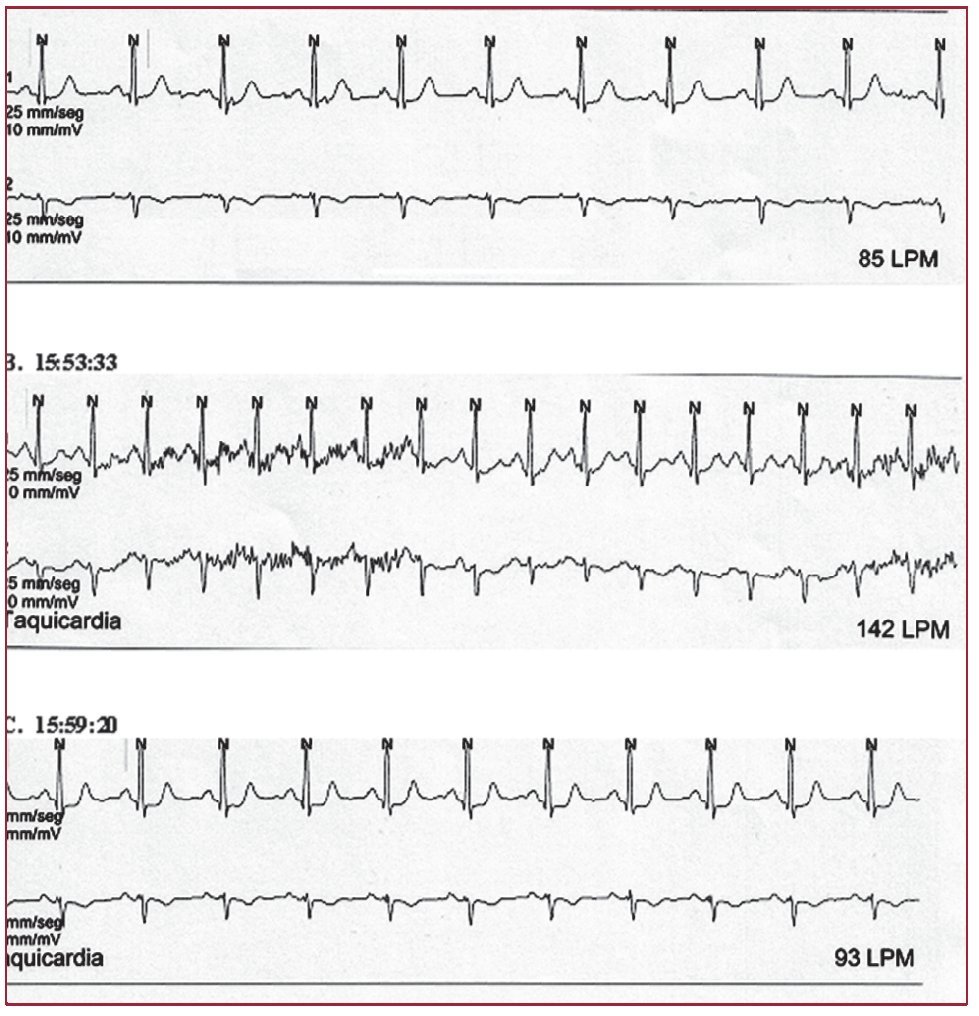 Ivabradina como alternativa terapéutica en la taquicardia sinusal ...