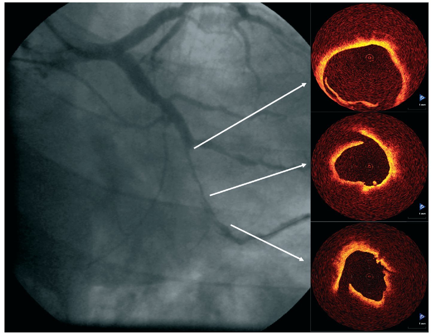 Disección arterial coronaria asistida por tomografía de coherencia óptica