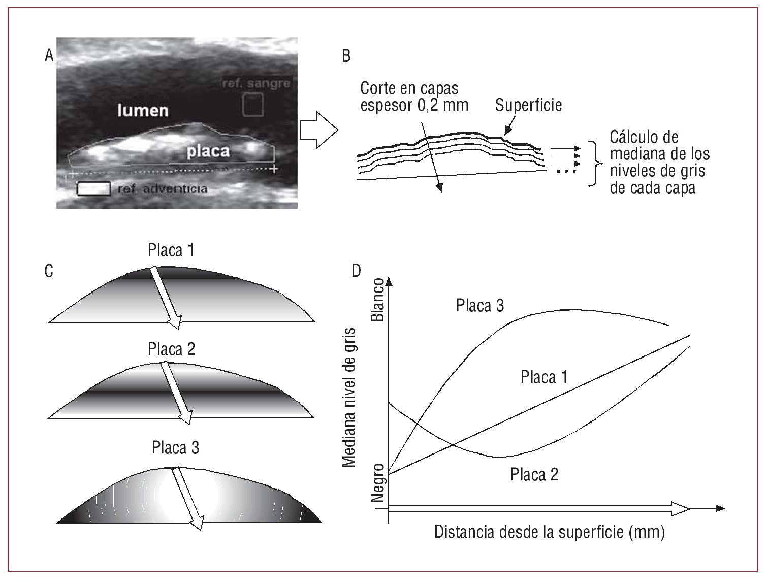 Placas de ateroma: descripción cuantitativa de la ecogenicidad por ...