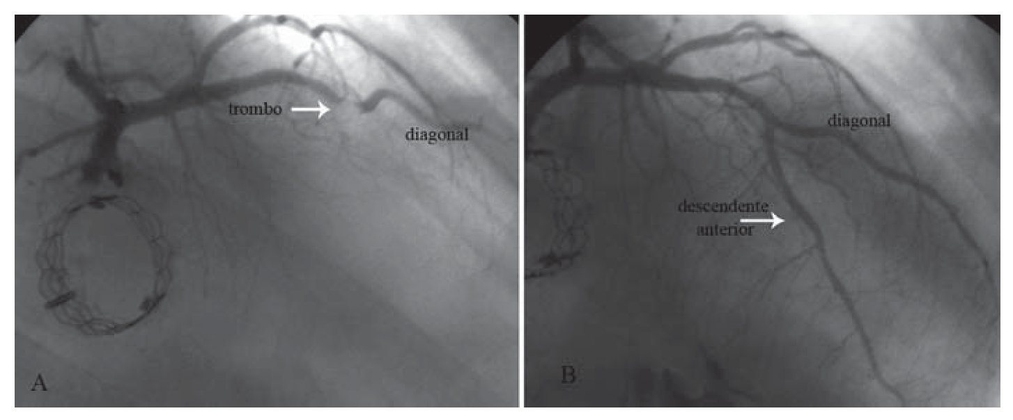 Embolia coronaria tras implante percutáneo de prótesis valvular aórtica