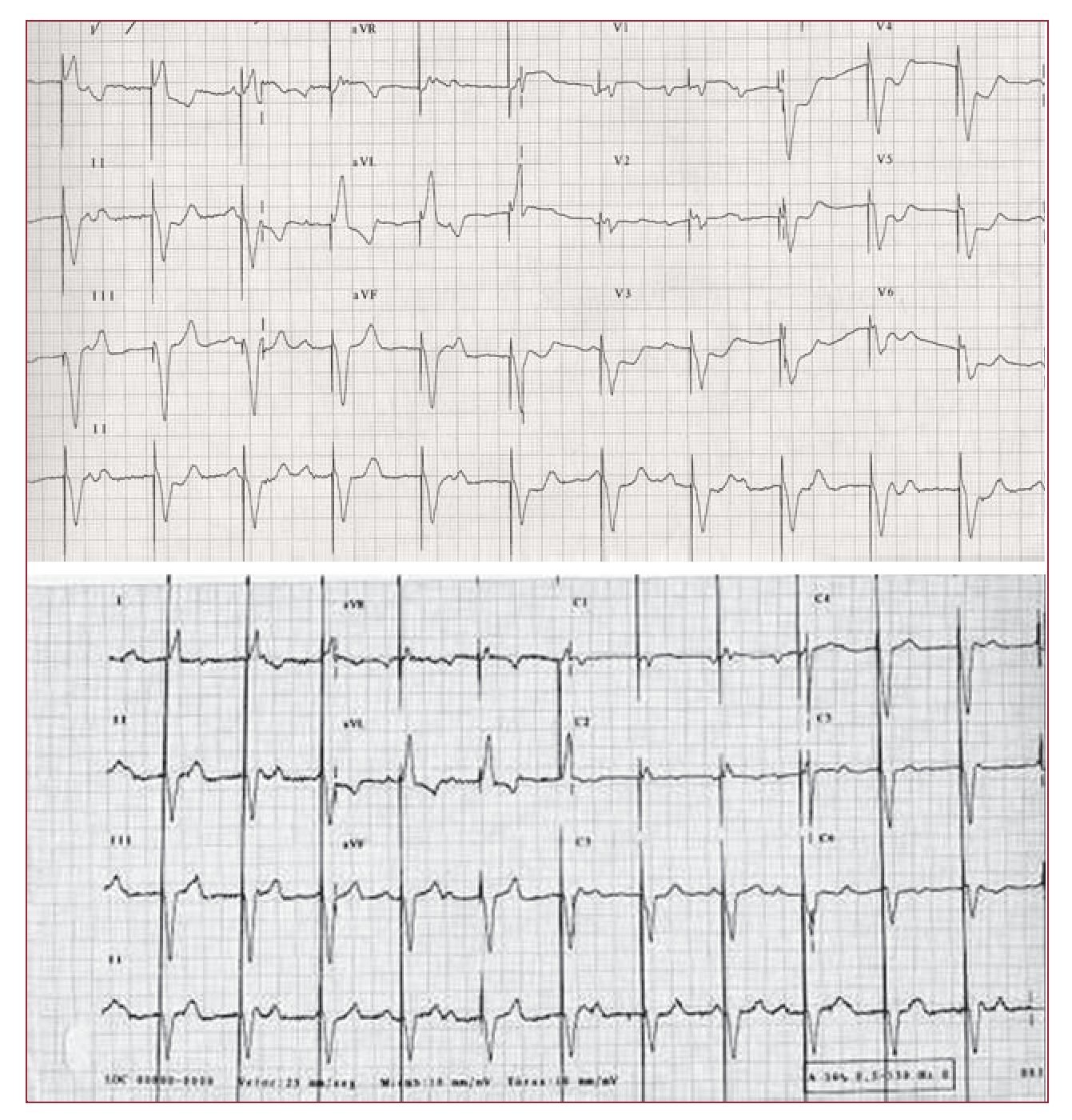 Diagnóstico electrocardiográfico de síndrome coronario agudo en ...