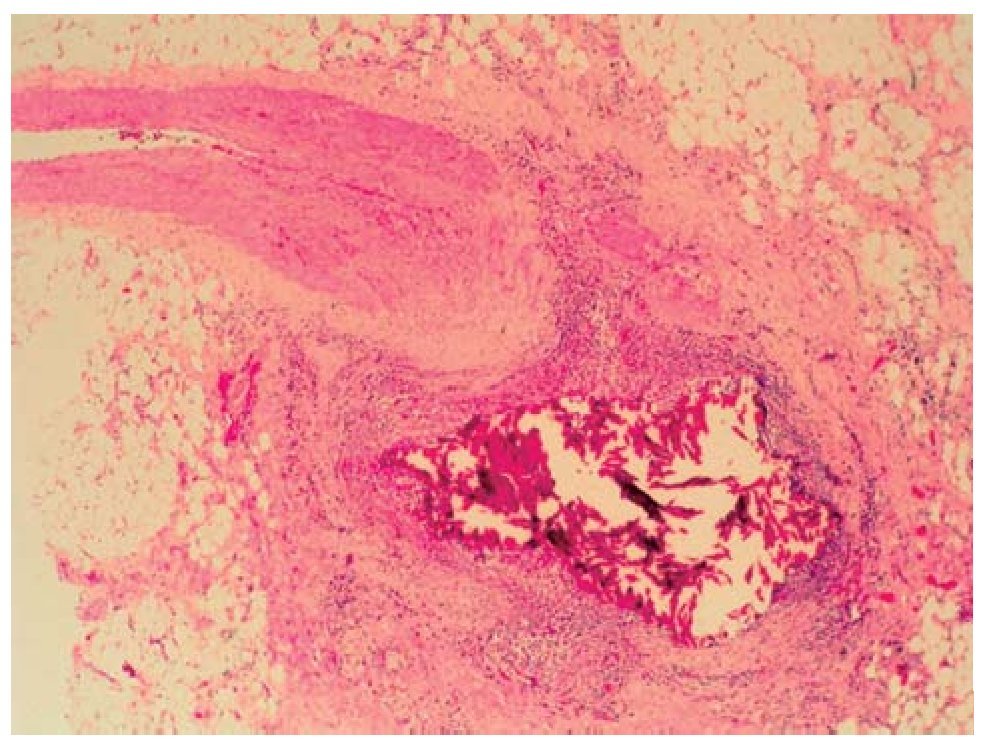Hallazgo incidental de embolia coronaria durante cirugía valvular ...