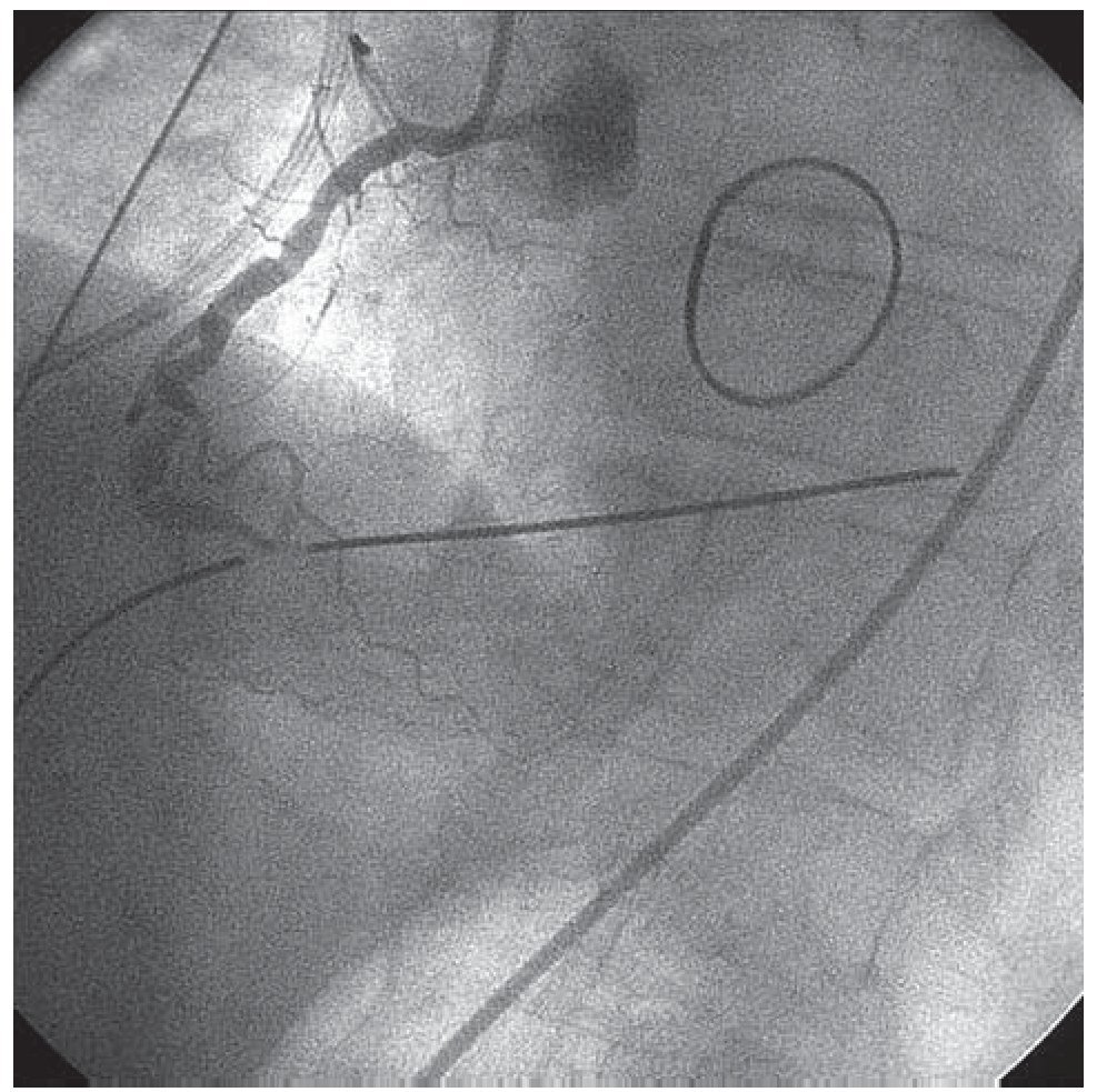 Lesión en la coronaria derecha como complicación de la anuloplastia ...