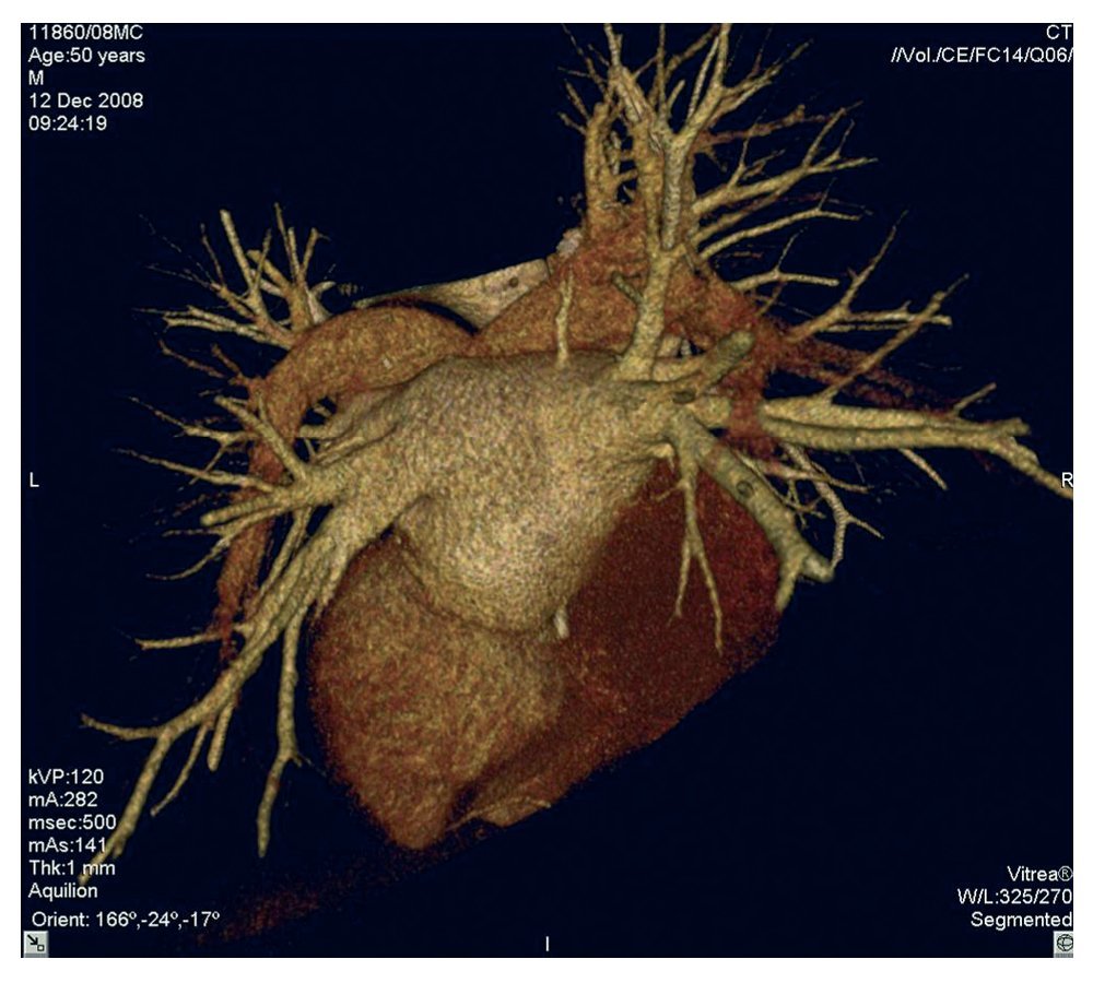 Vena pulmonar accesoria posterior y fibrilación auricular | Revista ...