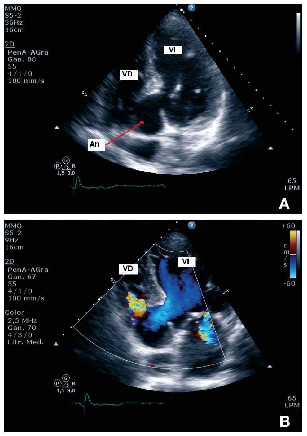 Aneurisma del septo interventricular con fistulización posterior a ...