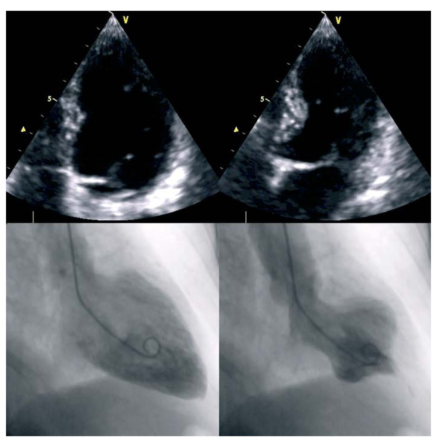 Síndrome de tako-tsubo. Una presentación atípica | Revista Española de ...