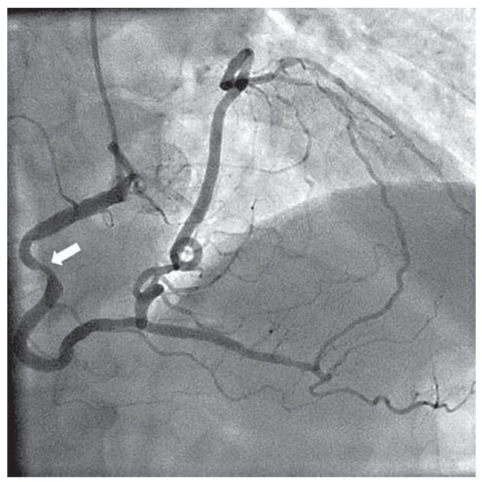 Lesión de alto riesgo en arteria coronaria única con nacimiento en el ...