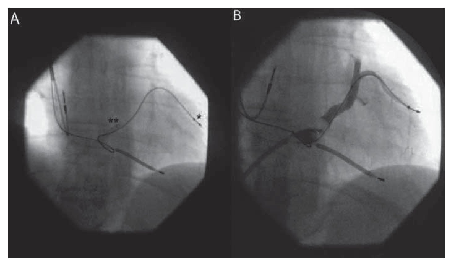 Recolocación percutánea tardía de electrodo de seno coronario para ...