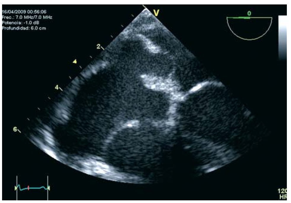 Foramen oval permeable y ventilación mecánica | Revista Española de ...