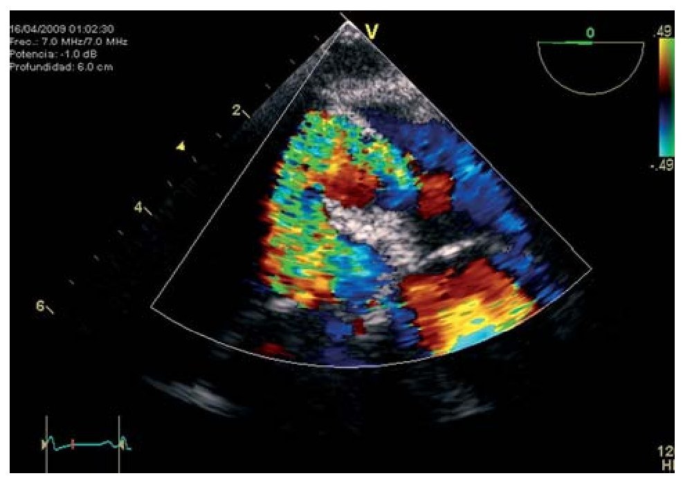 Foramen oval permeable y ventilación mecánica | Revista Española de ...