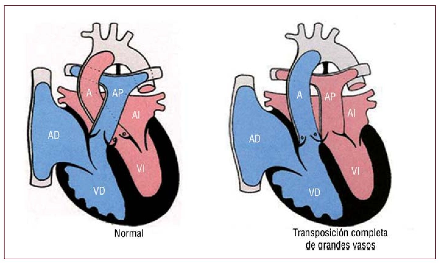 Ventrículo derecho y cardiopatías congénitas en el adulto | Revista ...