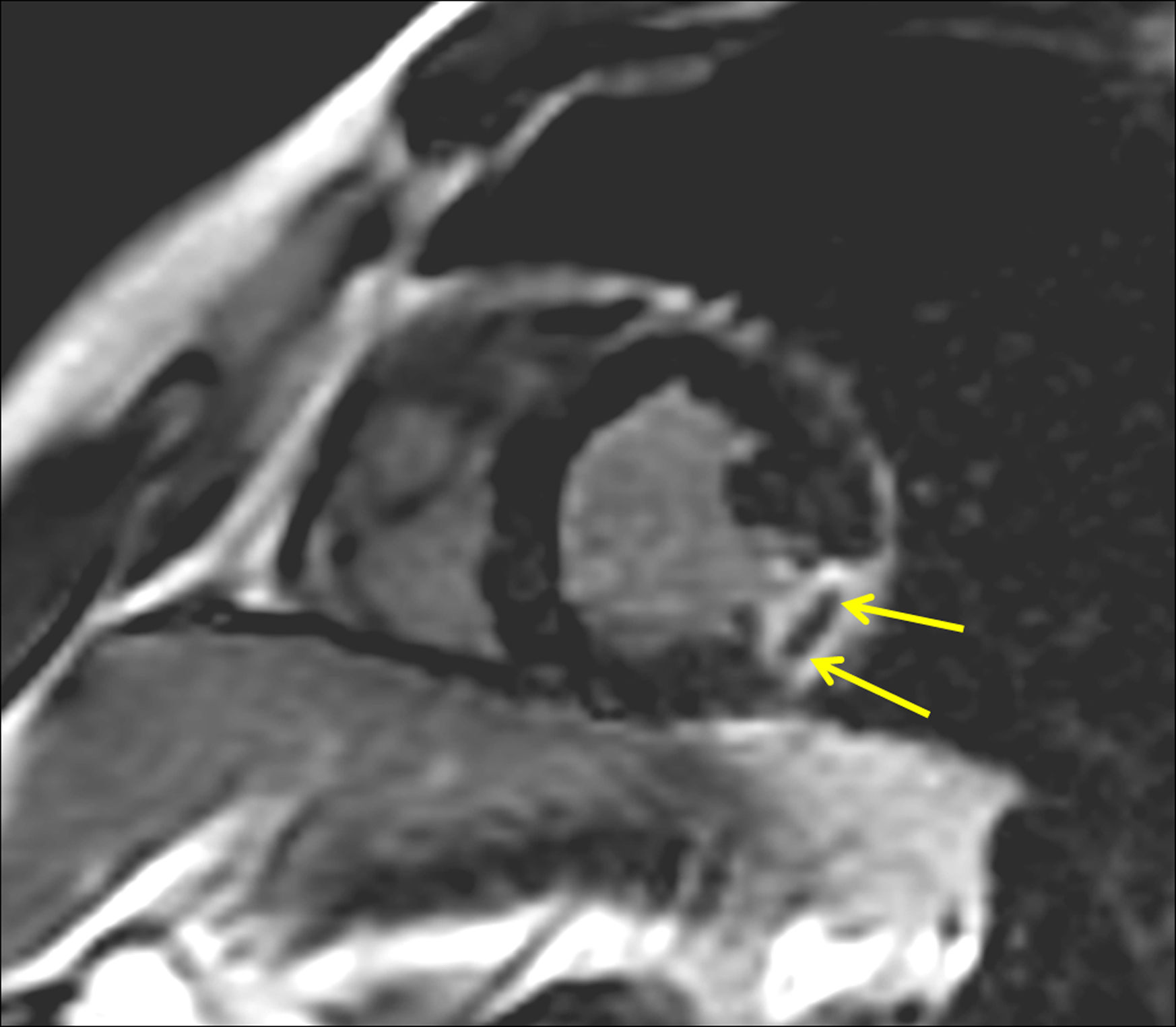 Utilidad de la determinación de endotelina-1 en el infarto agudo de ...