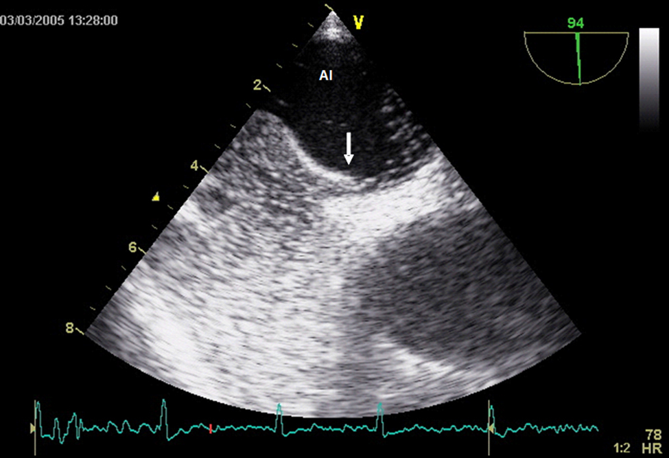 Diagnóstico y cuantificación del foramen oval permeable. ¿Cuál es la ...