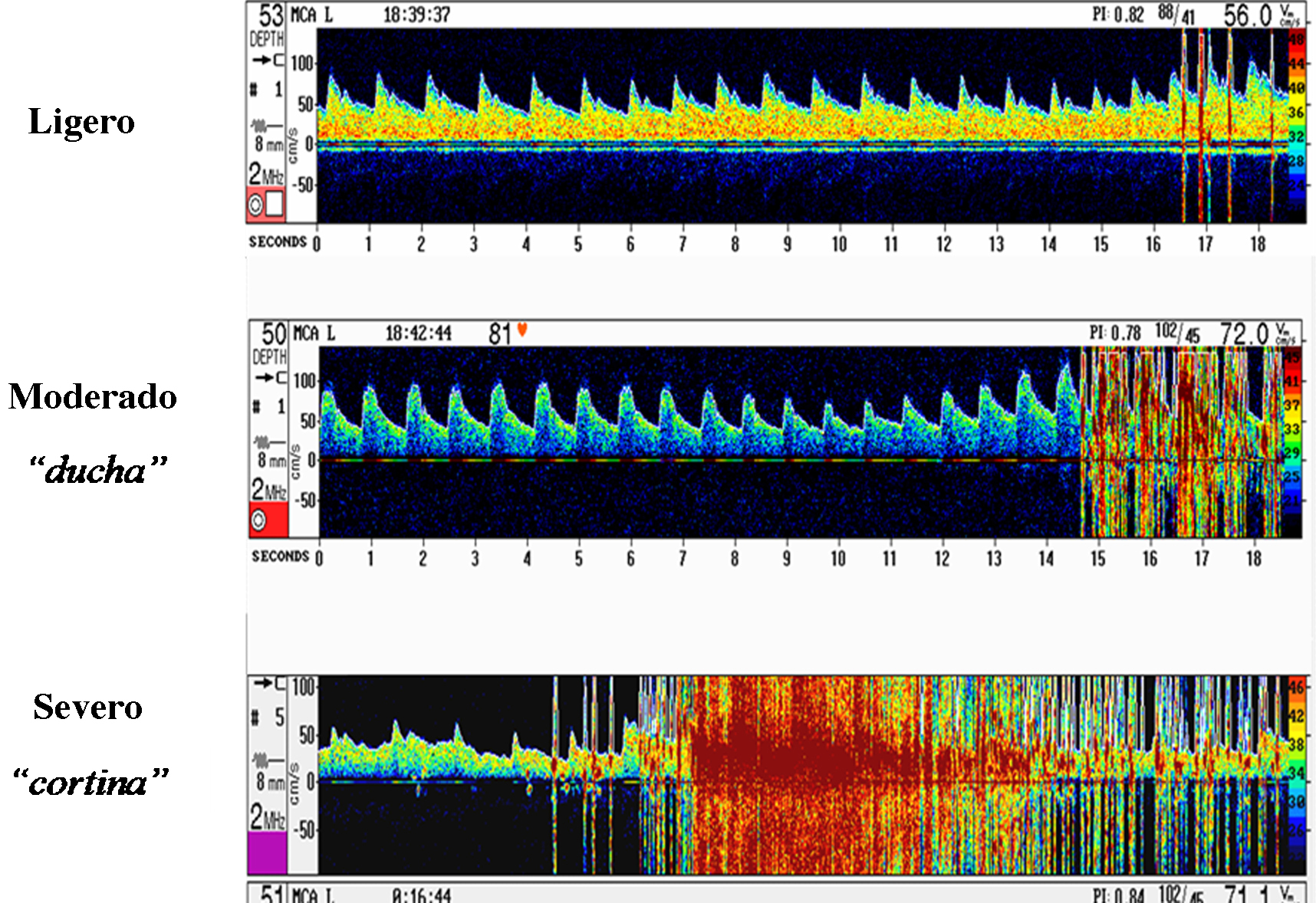 Diagnóstico y cuantificación del foramen oval permeable. ¿Cuál es la ...