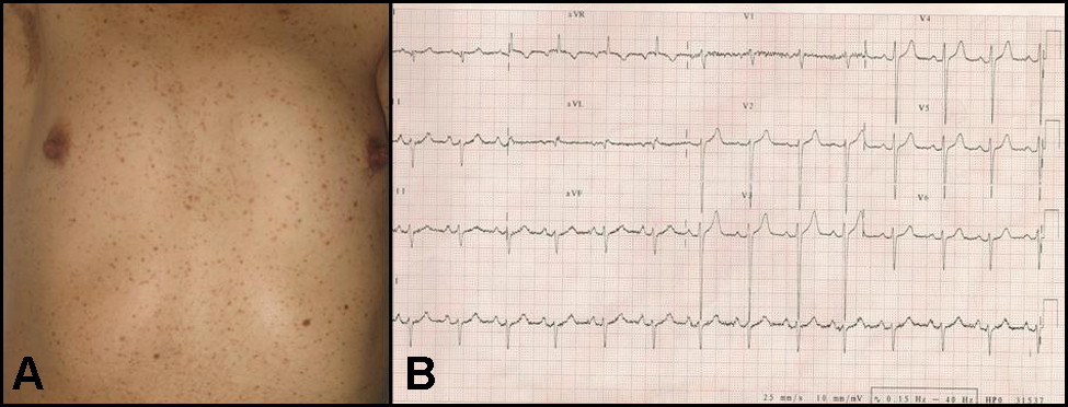 Anomalías cardiacas en el síndrome de LEOPARD | Revista Española de ...