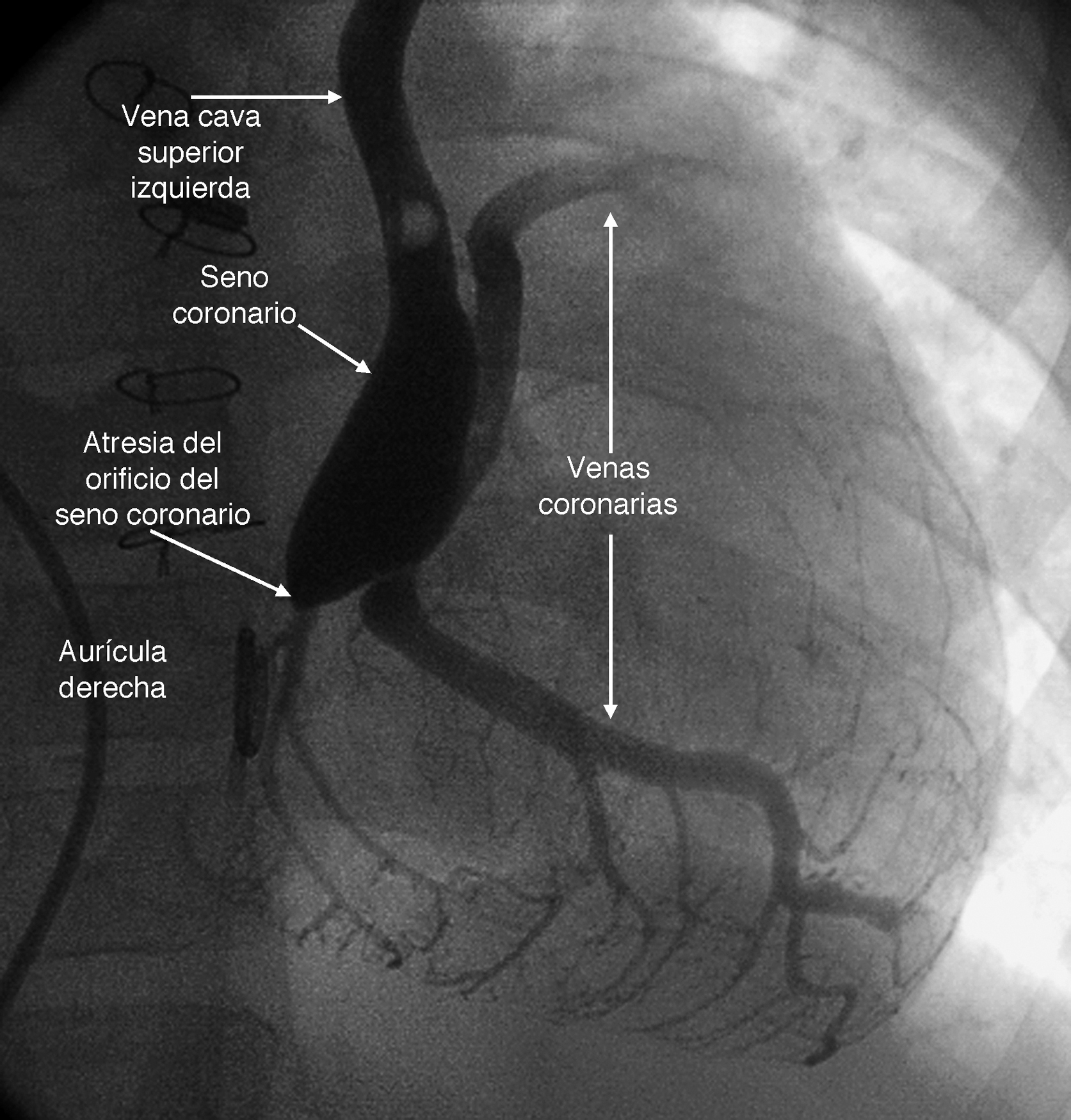 Atresia del orificio del seno coronario | Revista Española de Cardiología